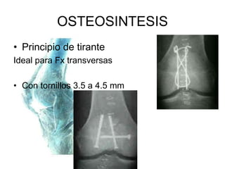32 FRACTURAS DE ROTULA (2).ppsx