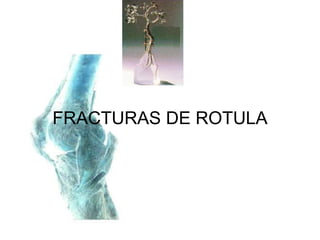 32 FRACTURAS DE ROTULA (2).ppsx