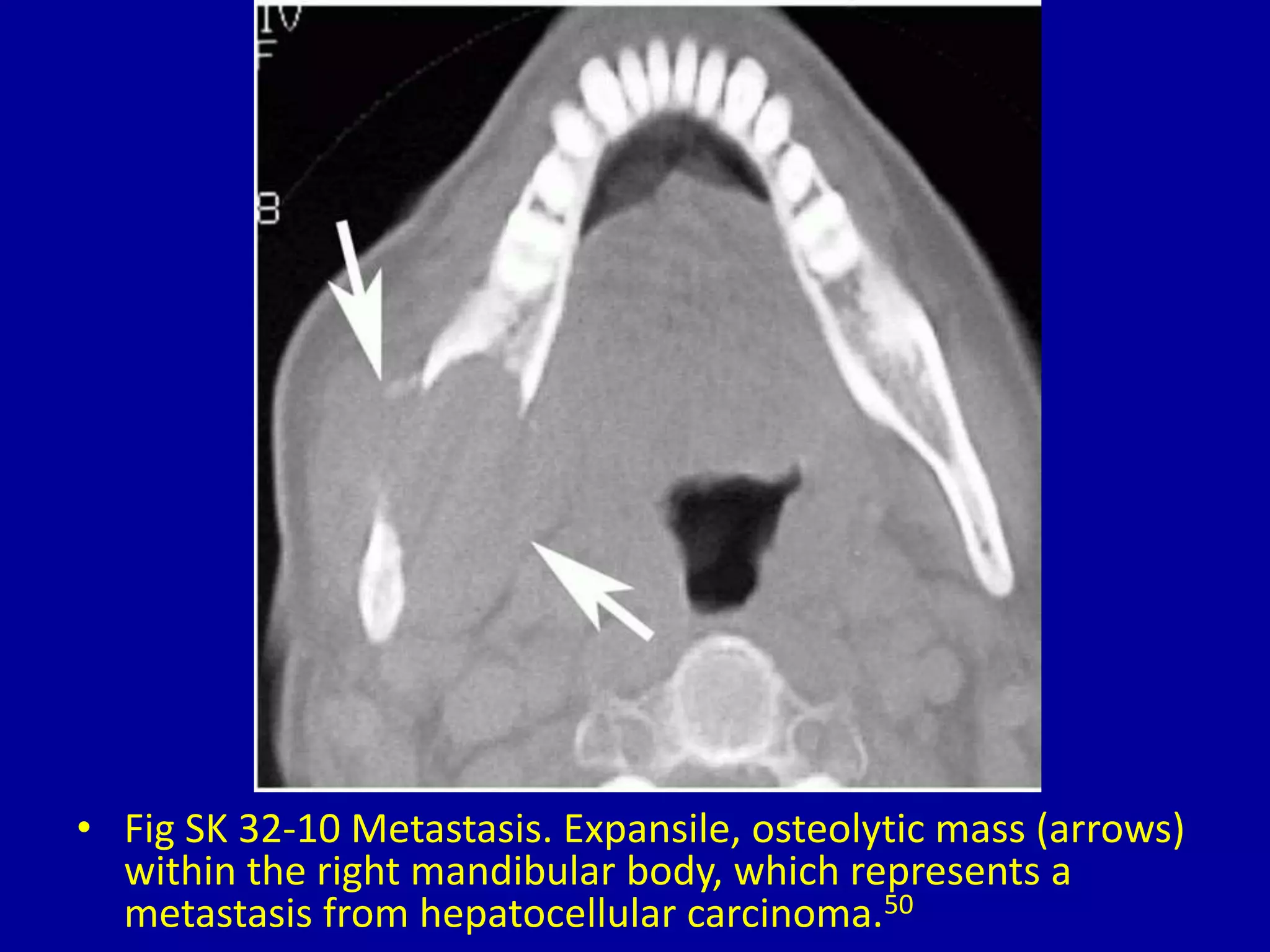 32 mandible lesions on computed tomography | PPTX | Dental Health ...