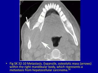 Torus Mandibularis Radiology
