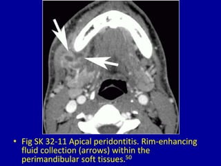 32 mandible lesions on computed tomography | PPTX | Dental Health ...