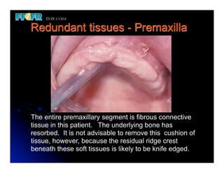 32(new).preprosthetic surgical procedures (n) | PPT