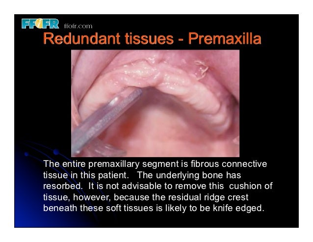 32(new).preprosthetic surgical procedures (n)