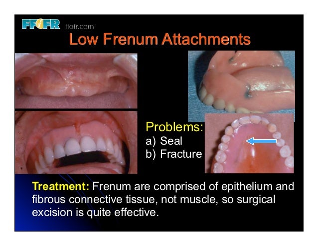 32(new).preprosthetic surgical procedures (n)