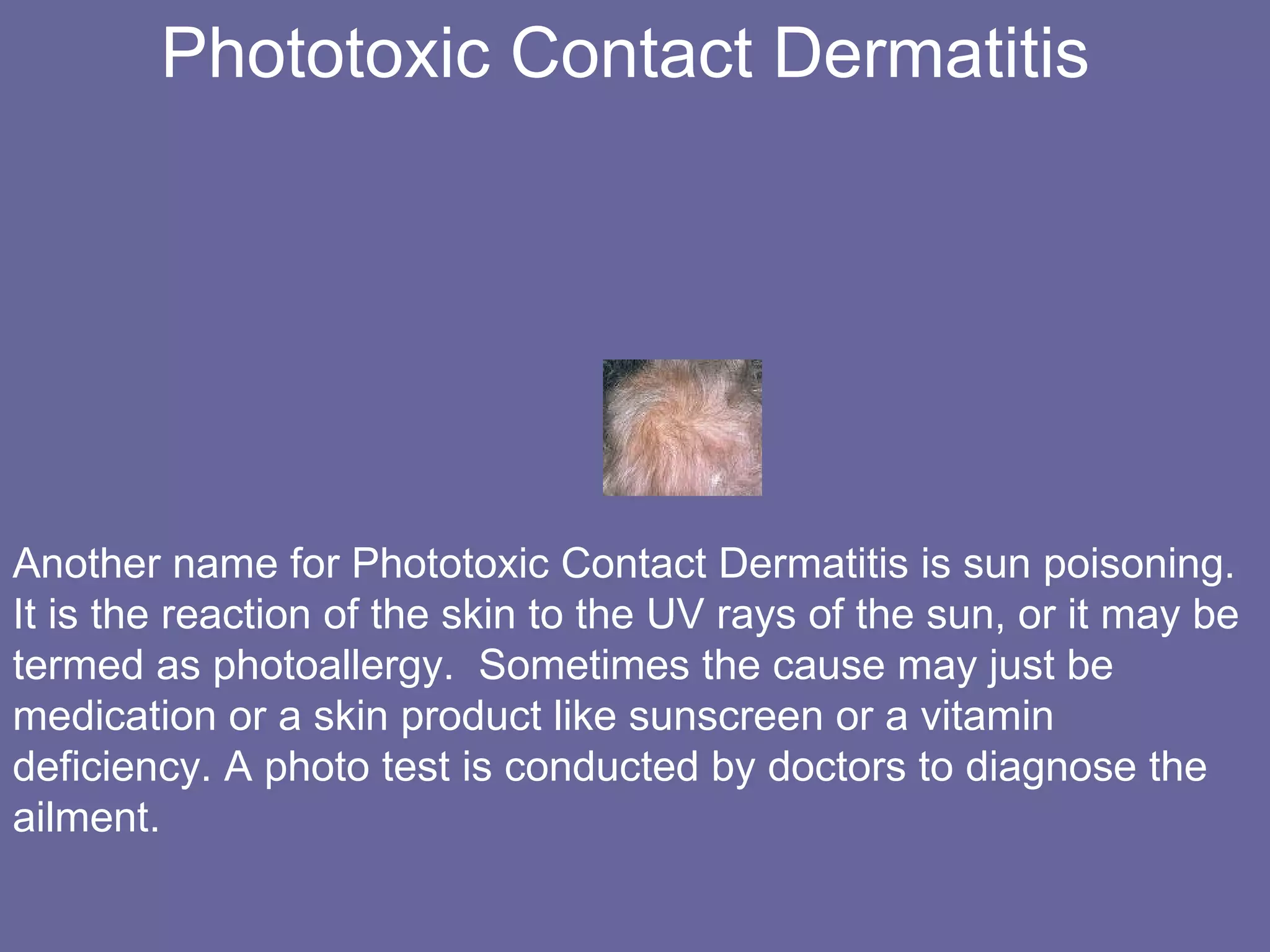 Phototoxic Contact Dermatitis is Similar to Sunburn | PPT