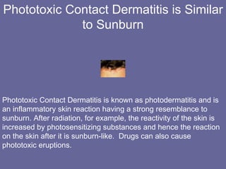 Phototoxic Contact Dermatitis is Similar to Sunburn | PPT
