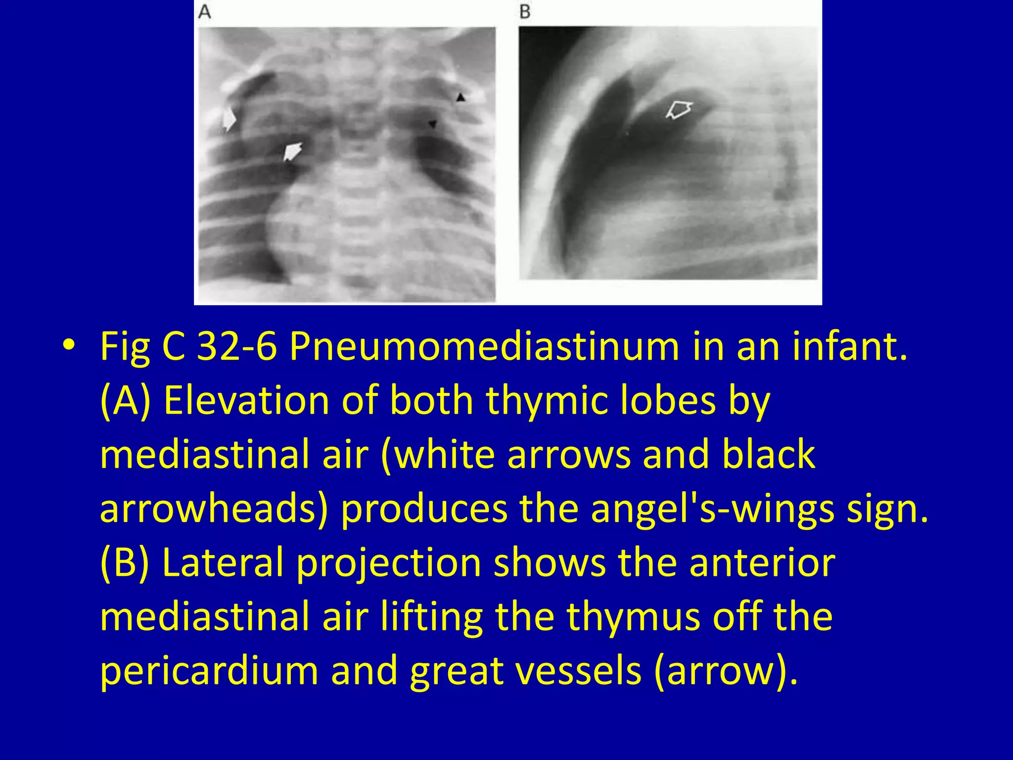 32 pneumomediastinum | PPT