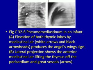 32 pneumomediastinum | PPTX