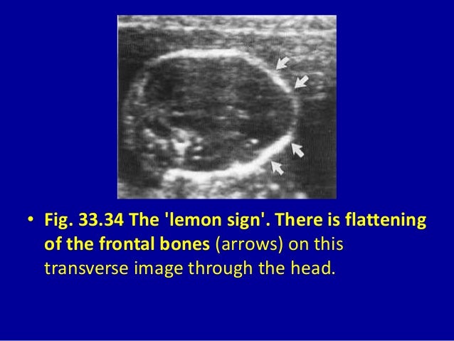 33 DAVID SUTTON PICTURES THE OBSTETRIC ULTRASOUND