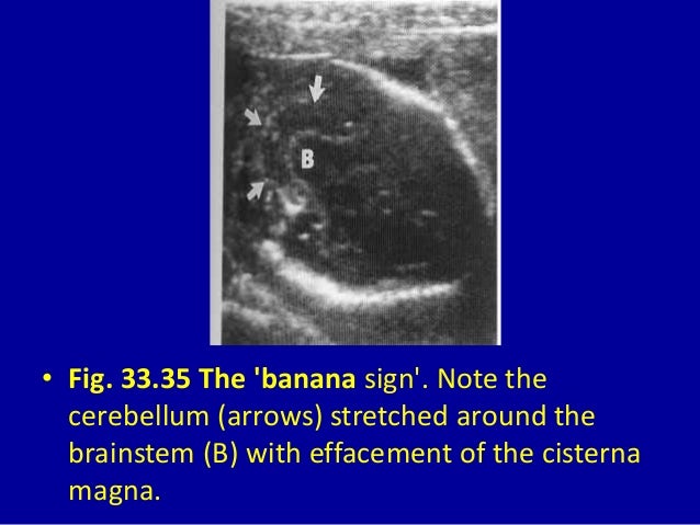 Banana Sign Ultrasound