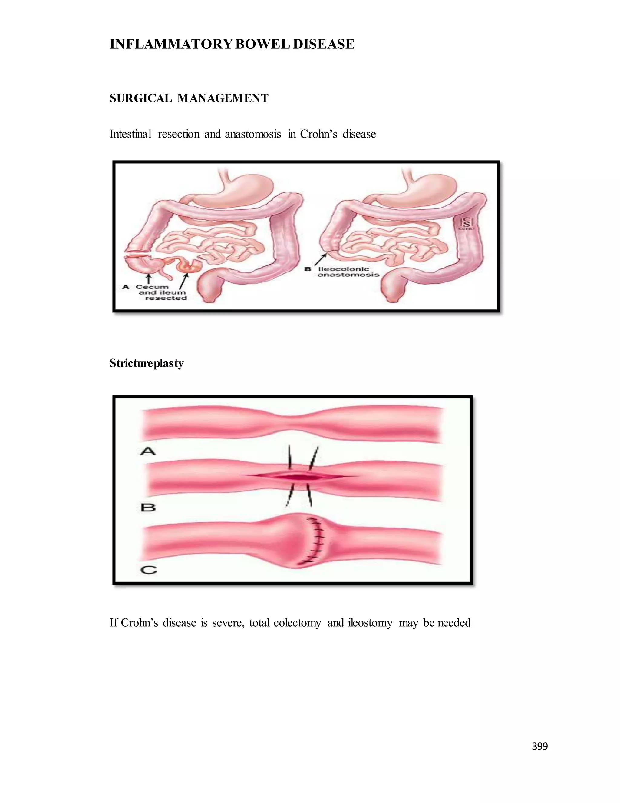 Inflammatory Bowel Disease | DOCX