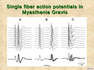 33. SFEMG in diseases | PPT