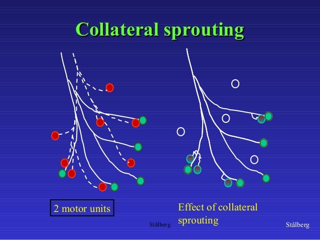 33. SFEMG in diseases