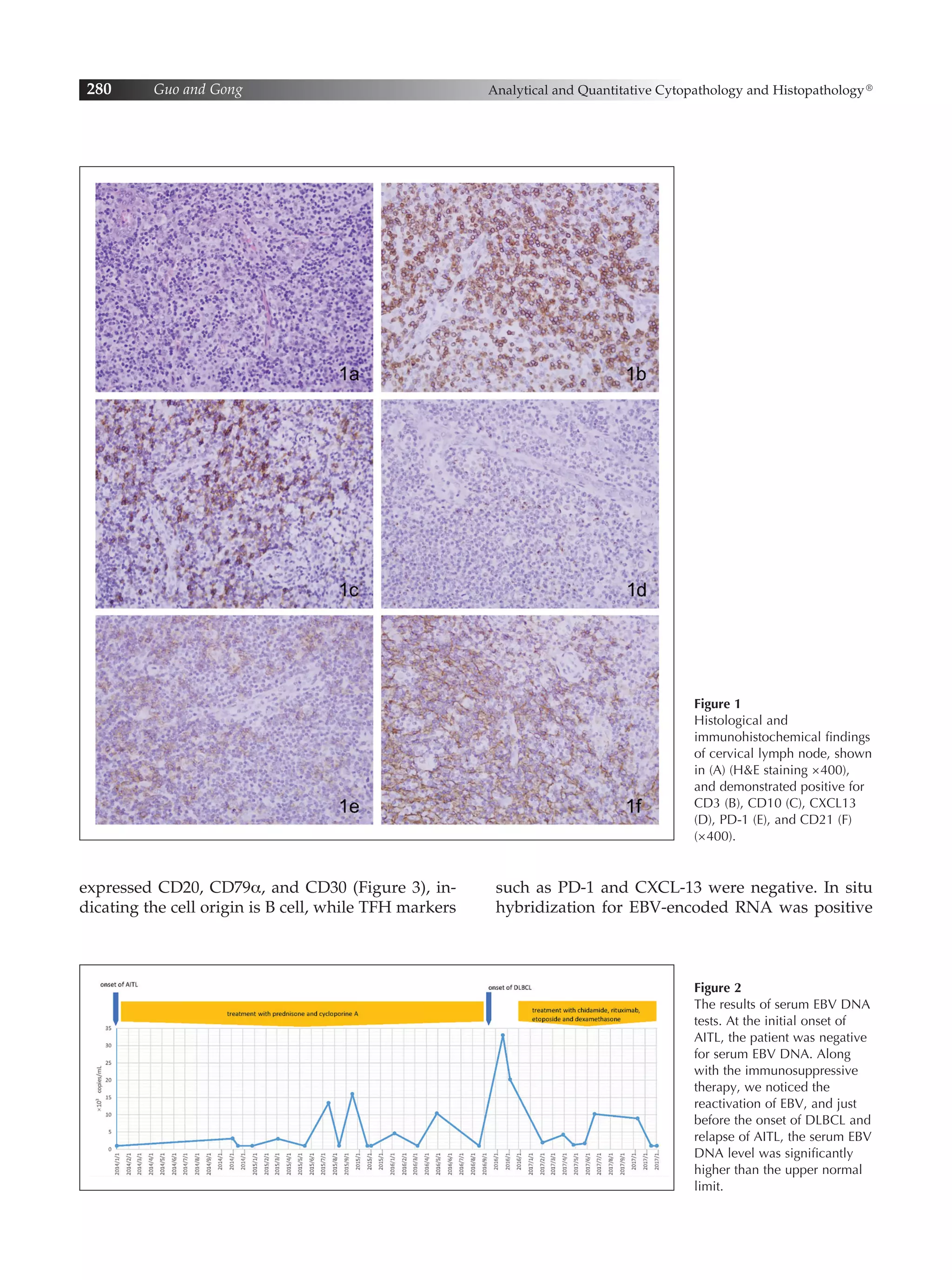 Subcutaneous Epstein-Barr Virus–Positive Diffuse Large B Cell Lymphoma Following ...