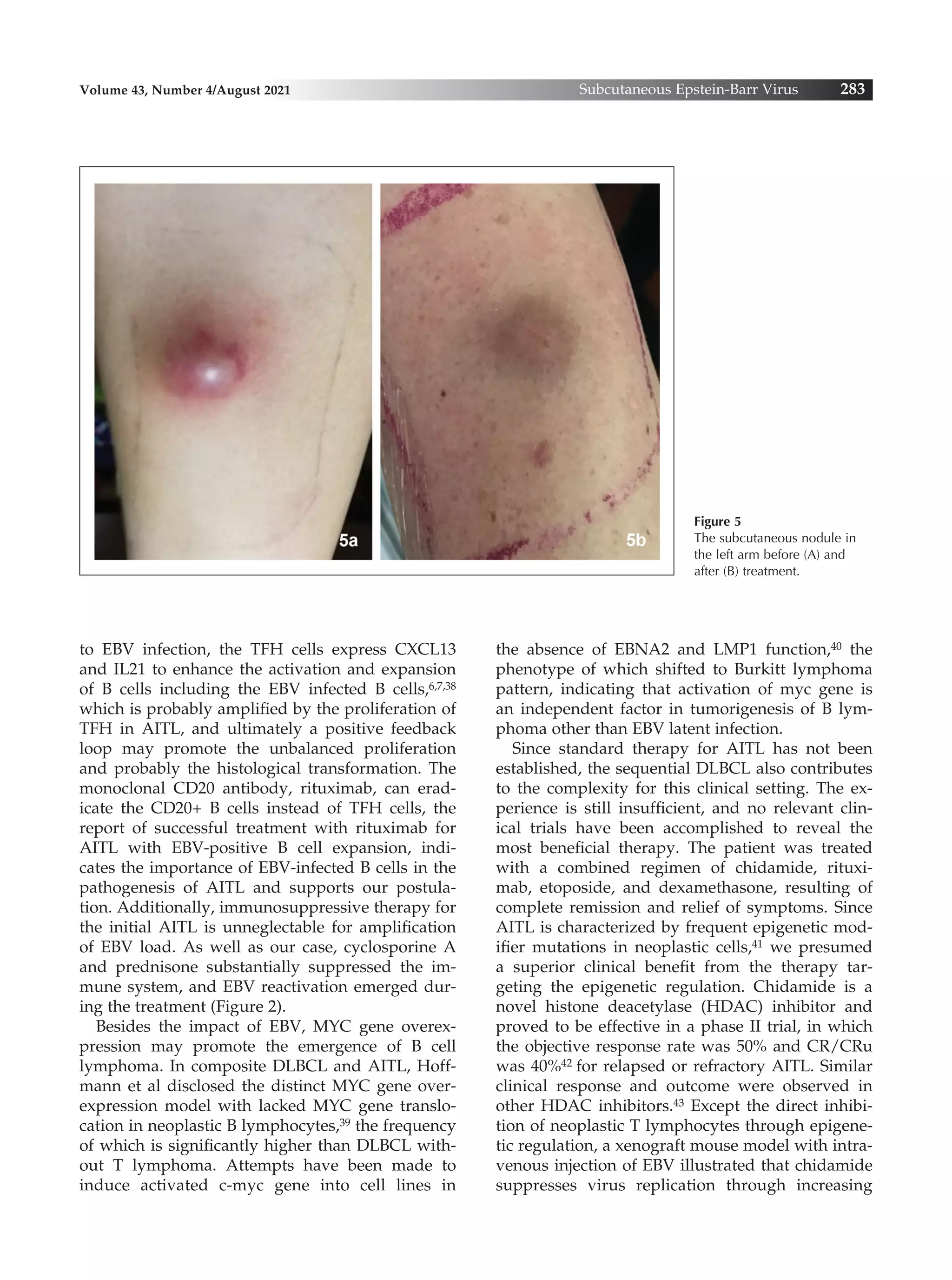 Subcutaneous Epstein-Barr Virus–Positive Diffuse Large B Cell Lymphoma Following ...