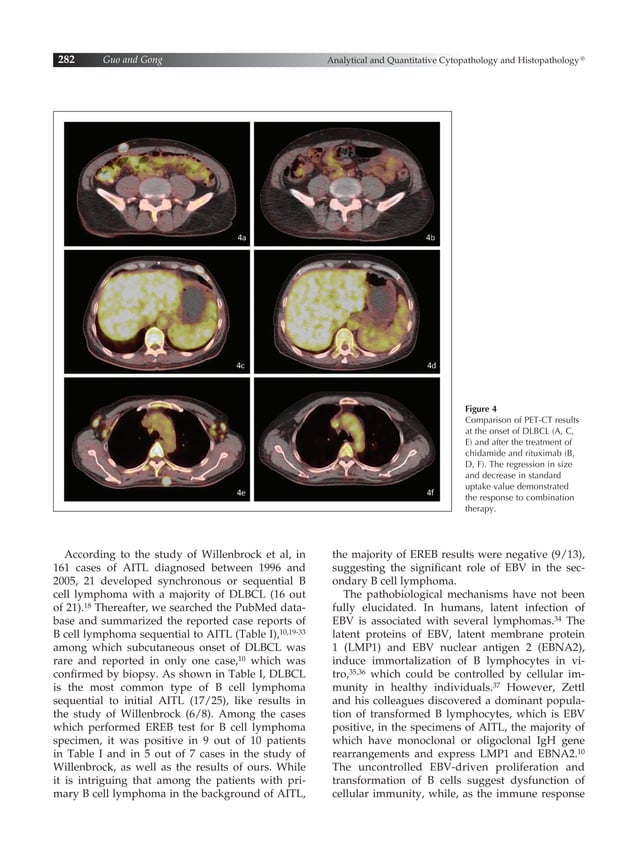 Subcutaneous Epstein-Barr Virus–Positive Diffuse Large B Cell Lymphoma Following ...