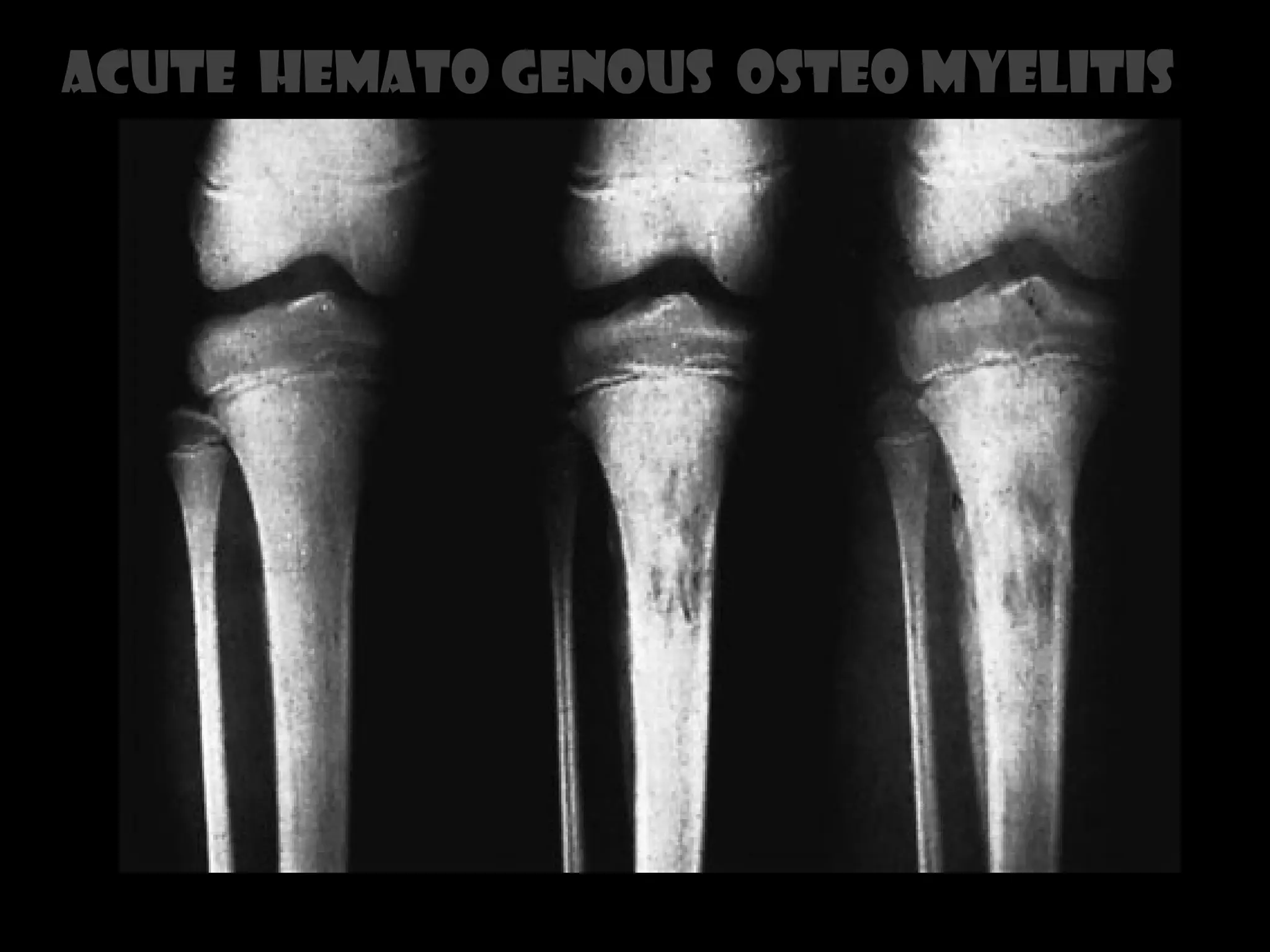 Acute hematogenous osteomylitis ttt and complications.pptx