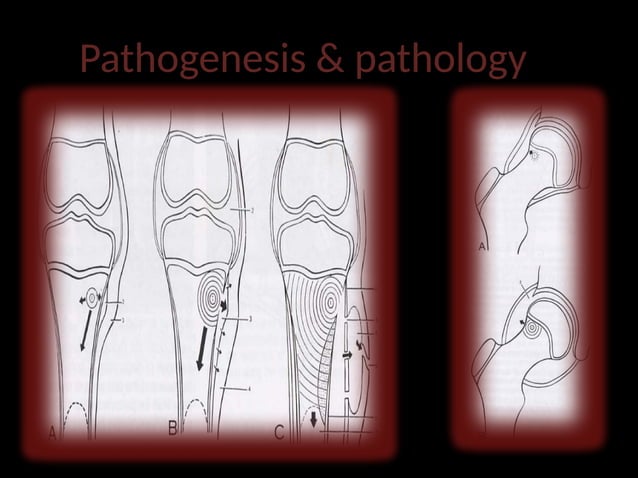 Acute hematogenous osteomylitis ttt and complications.pptx