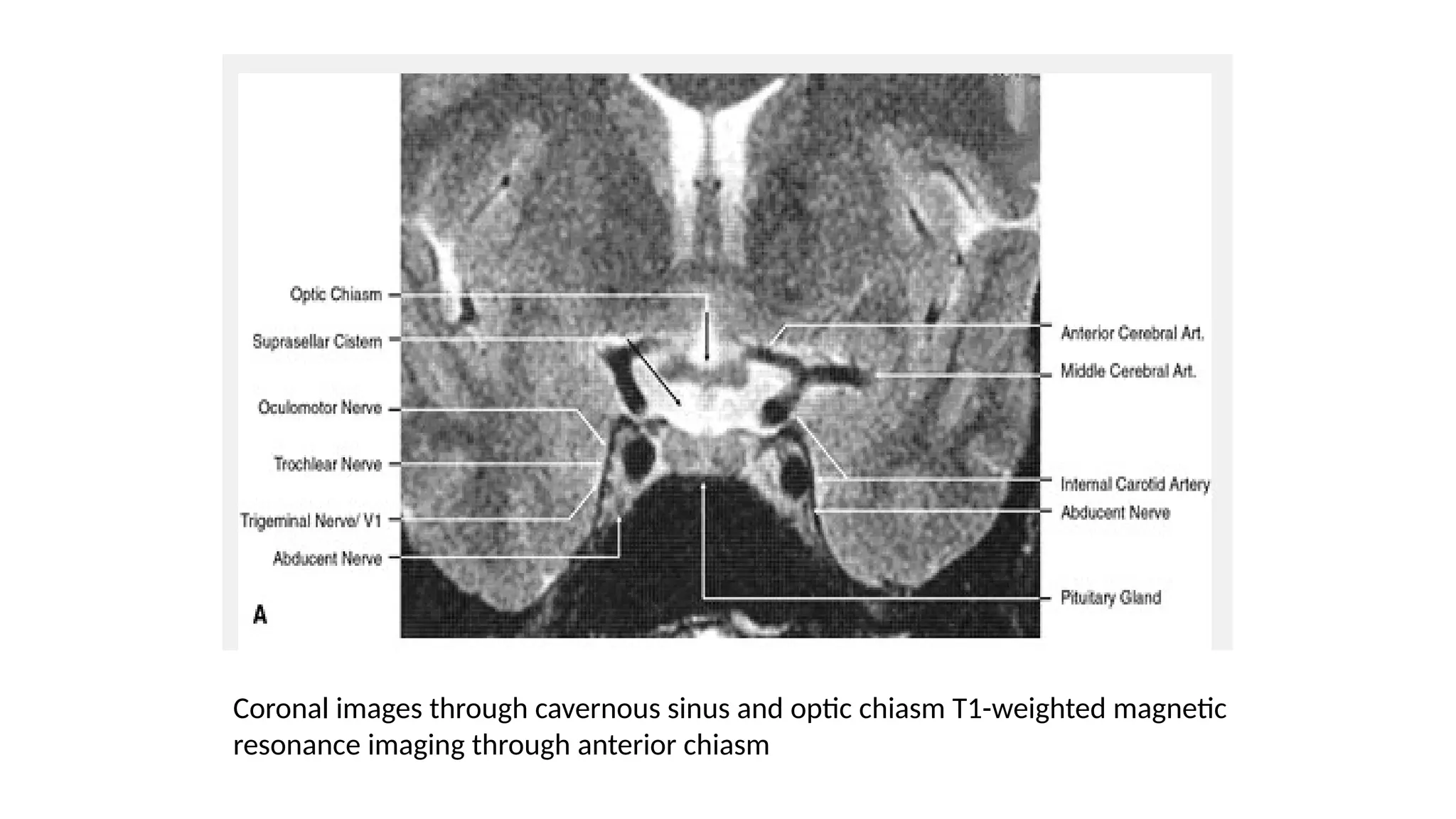 33. Orbital CT and MRI complete rahul.pptx