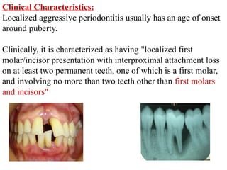 33.AGGRESSIVE PERIODONTITIs and it's pathophysiology and classification ...