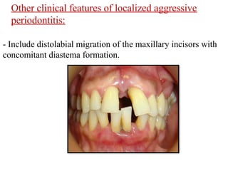 33.AGGRESSIVE PERIODONTITIs and it's pathophysiology and classification ...