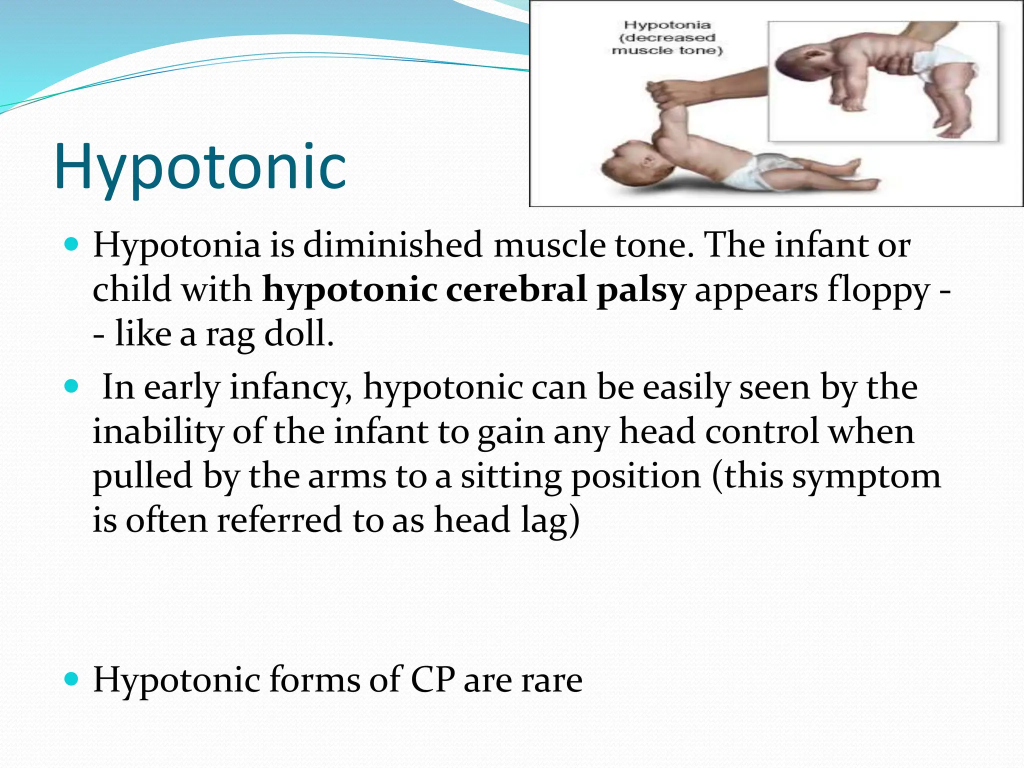 33- Cerebral Palsy.pptx