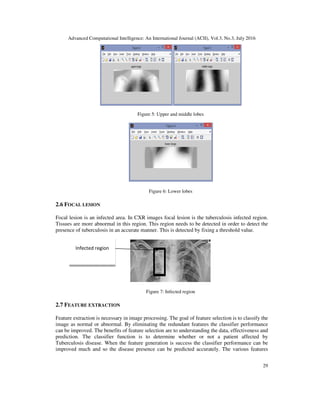 Detection of Tuberculosis Using Chest X Ray (CXR) | PDF