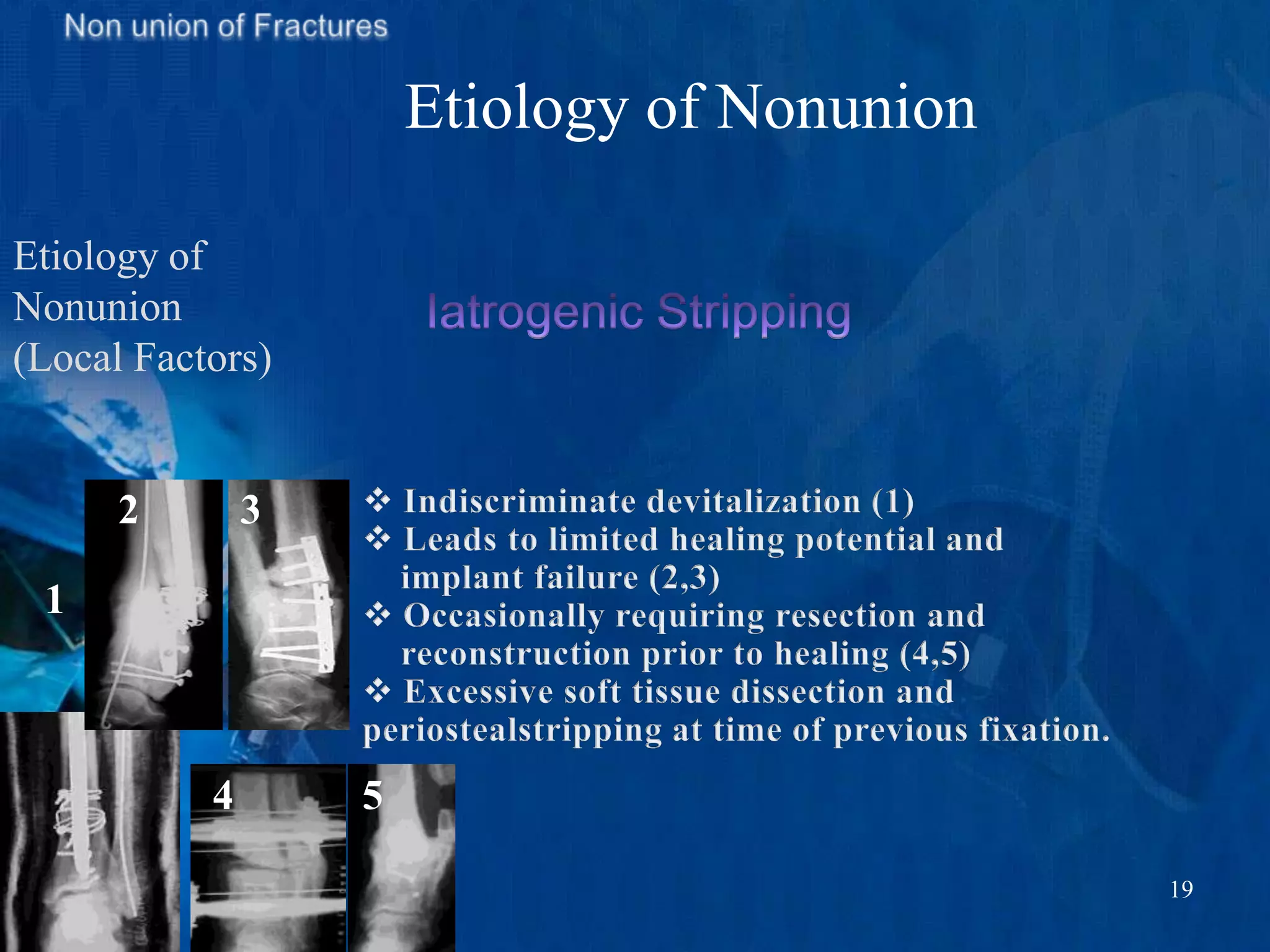 bone-fractures-nonunion-diagnosis-and-management-at-shaheed-suhrawardy ...