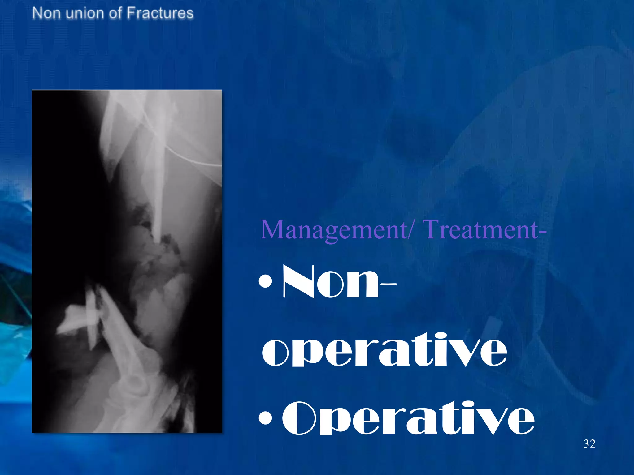 bone-fractures-nonunion-diagnosis-and-management-at-shaheed-suhrawardy ...