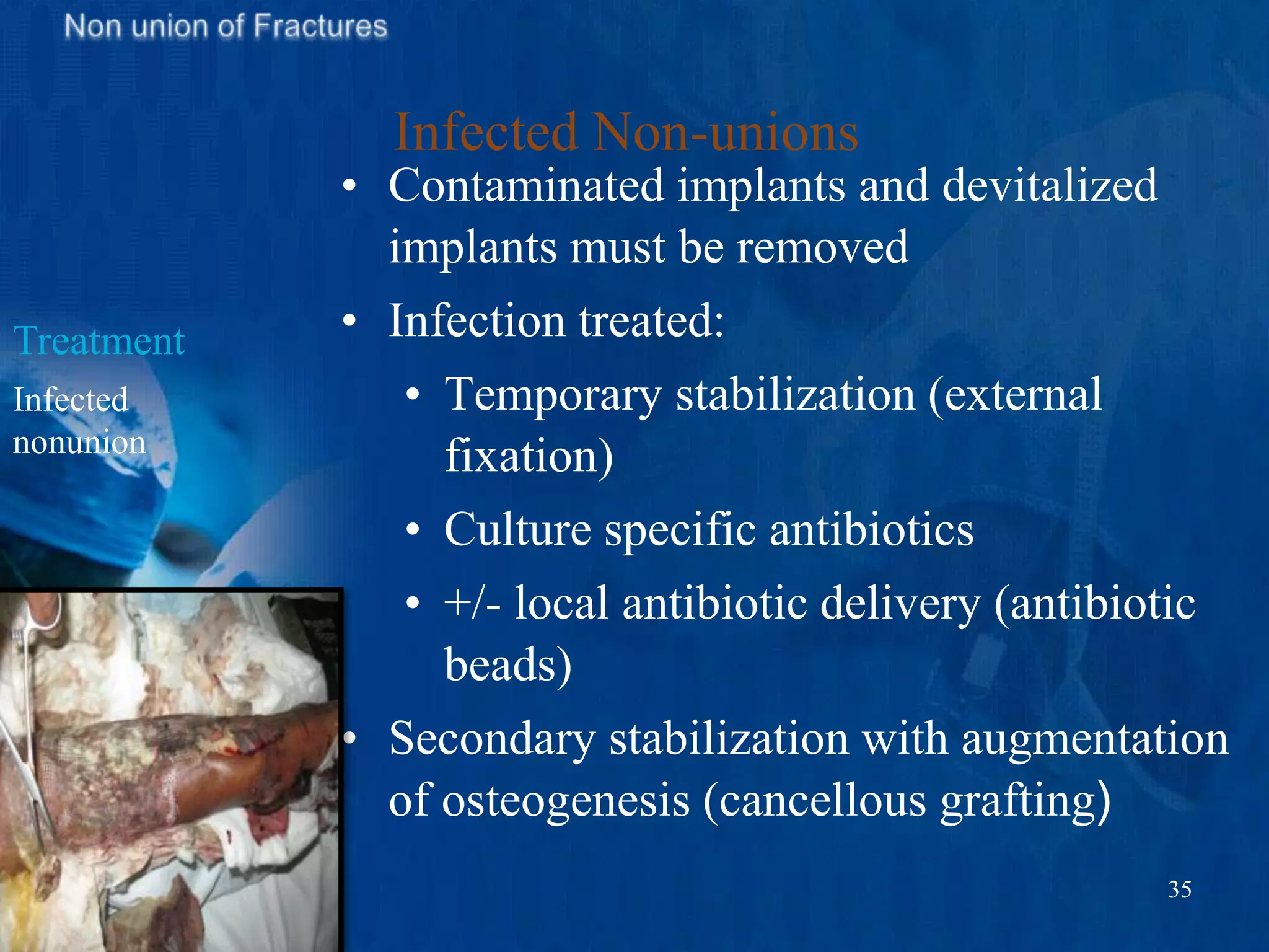 bone-fractures-nonunion-diagnosis-and-management-at-shaheed-suhrawardy ...