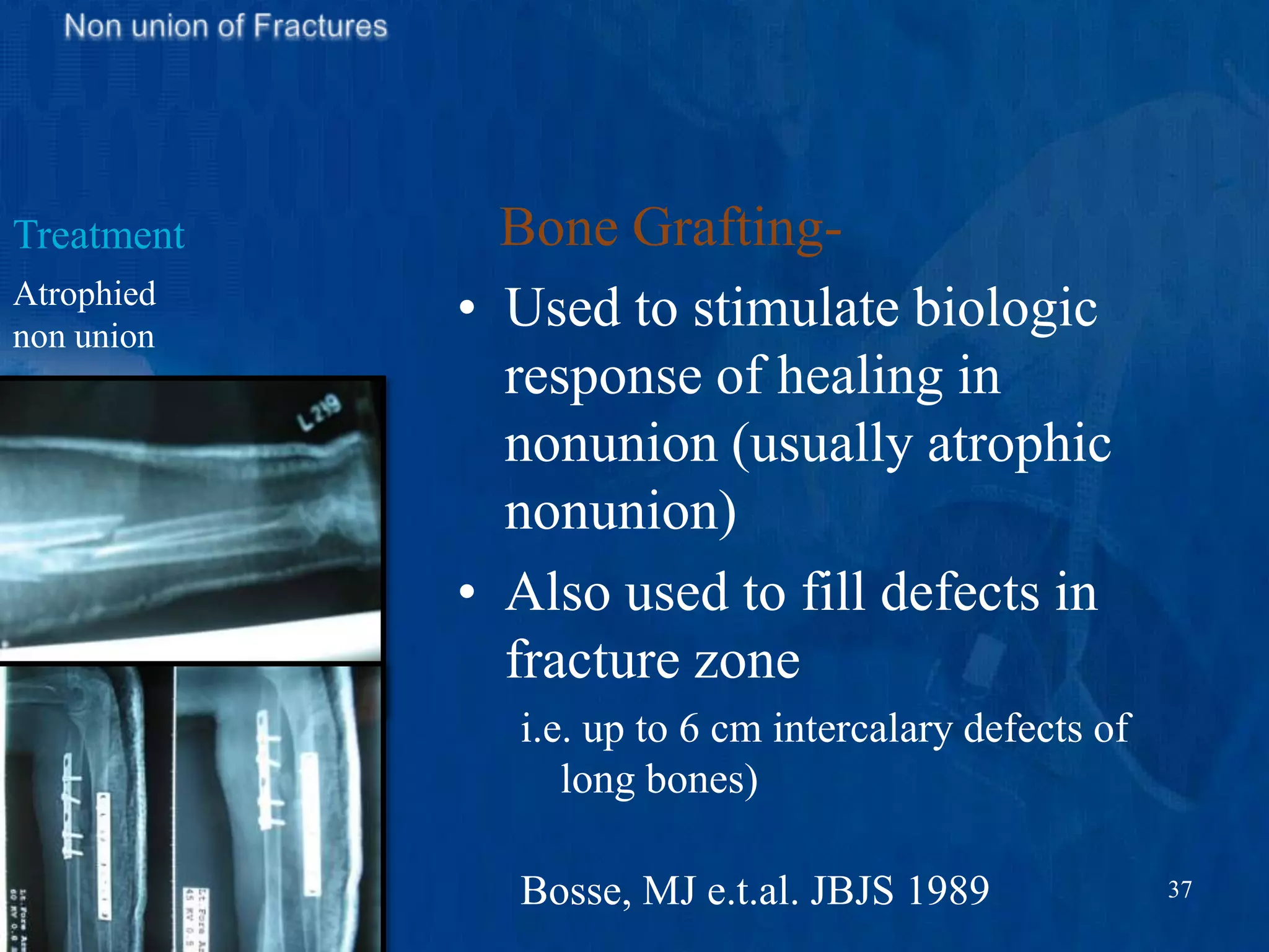 bone-fractures-nonunion-diagnosis-and-management-at-shaheed-suhrawardy ...