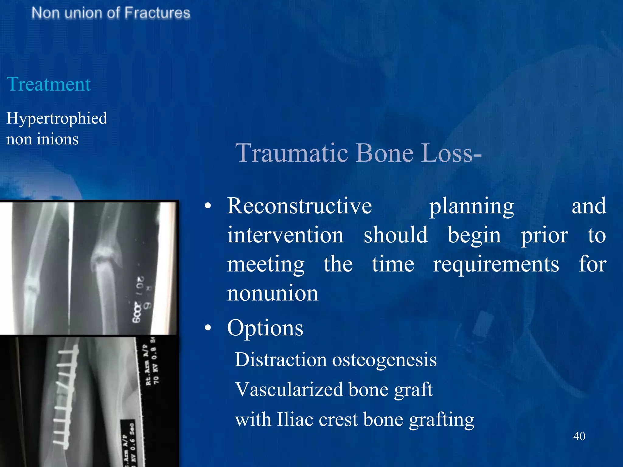 bone-fractures-nonunion-diagnosis-and-management-at-shaheed-suhrawardy ...