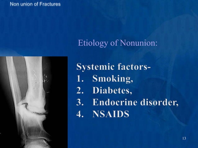 bone-fractures-nonunion-diagnosis-and-management-at-shaheed-suhrawardy ...