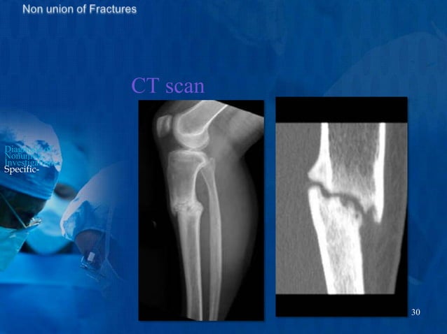 bone-fractures-nonunion-diagnosis-and-management-at-shaheed-suhrawardy ...