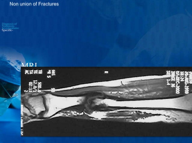 bone-fractures-nonunion-diagnosis-and-management-at-shaheed-suhrawardy ...