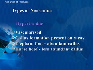 bone-fractures-nonunion-diagnosis-and-management-at-shaheed-suhrawardy ...