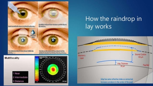 Intra Corneal Inlays For Presbyopic Correction