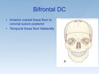 338 Indications and technique for cranial decompression after traumatic ...
