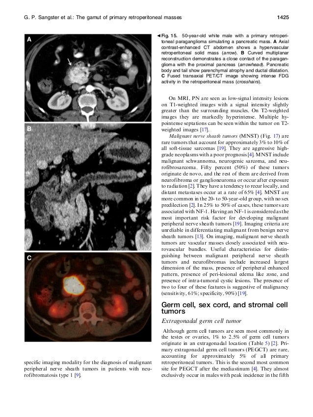 Retroperitoneal Tumors 7 16