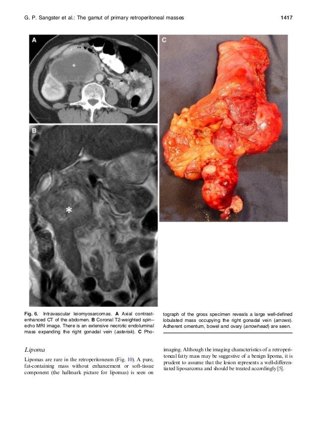 Retroperitoneal Tumors 7 16