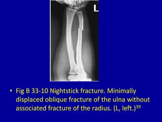 33 eponyms of fractures | PPTX