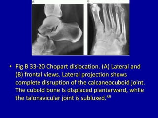 33 eponyms of fractures | PPTX