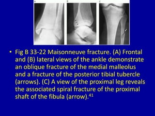33 eponyms of fractures | PPTX