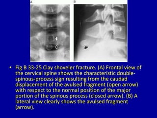 33 eponyms of fractures | PPTX