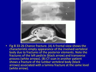 33 eponyms of fractures | PPTX