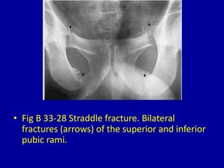 Straddle Fracture