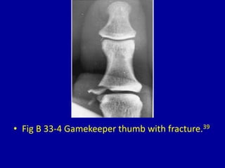 33 eponyms of fractures | PPTX