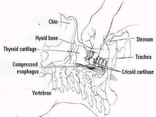 33)Esophageal Tracheal Combitube | PPT