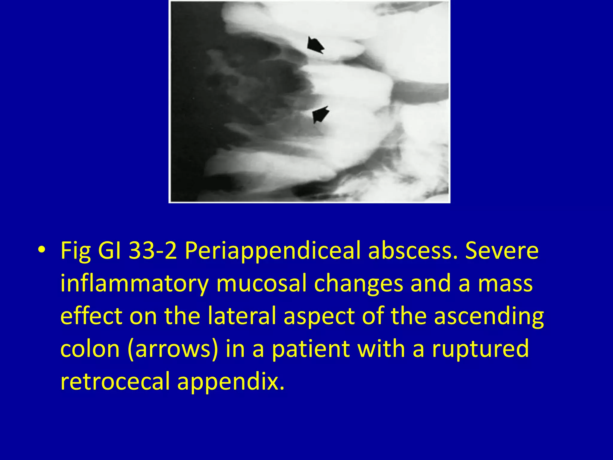 33 filling defects in the cecum | PPTX