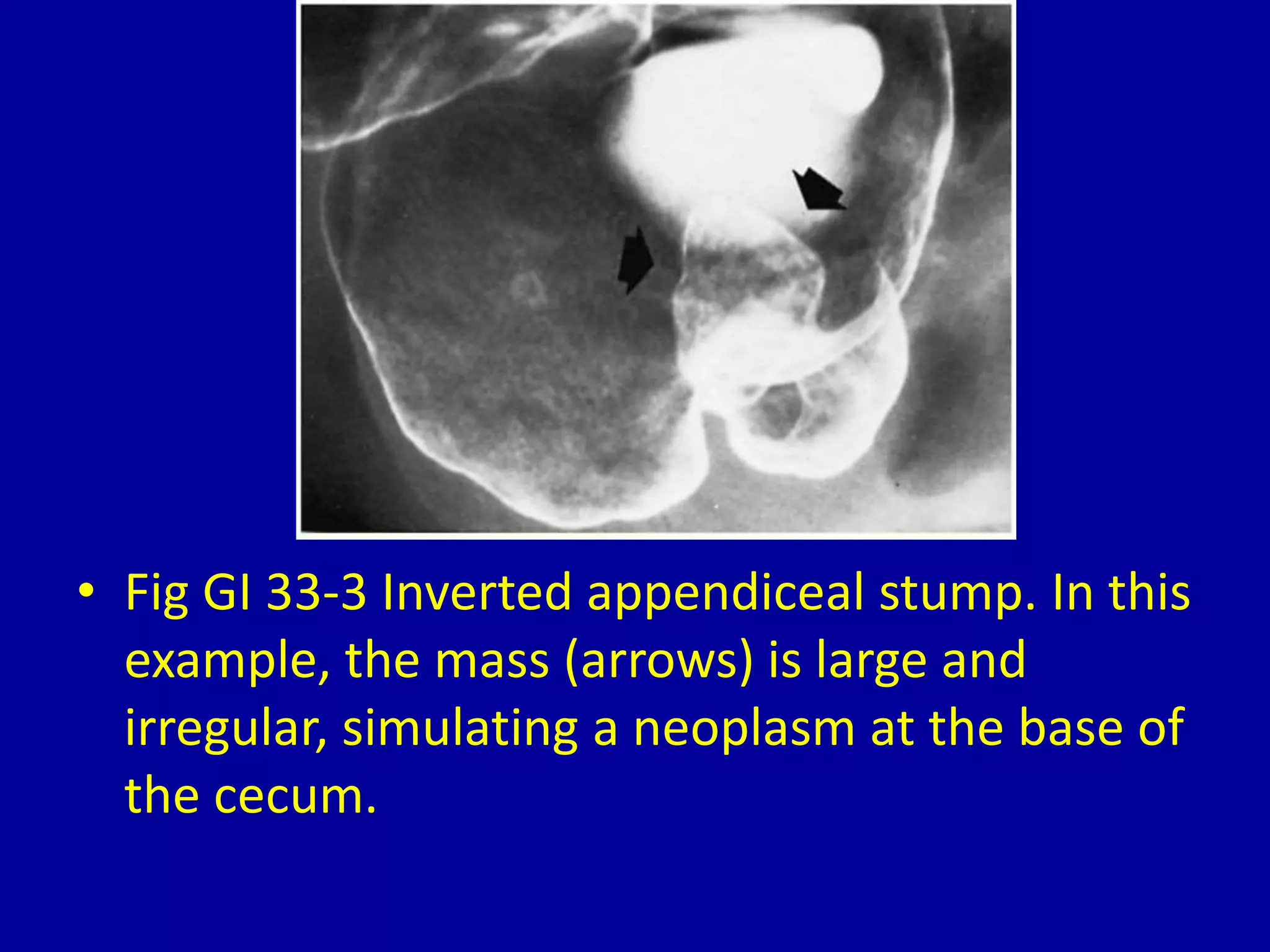 33 filling defects in the cecum | PPTX